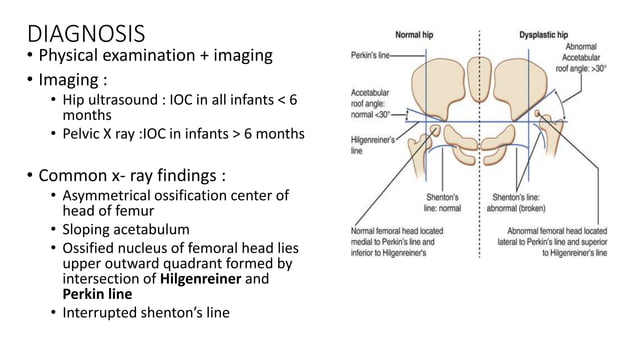 ANATOMY OF HIP JOINT , ROM & DDH.pptx