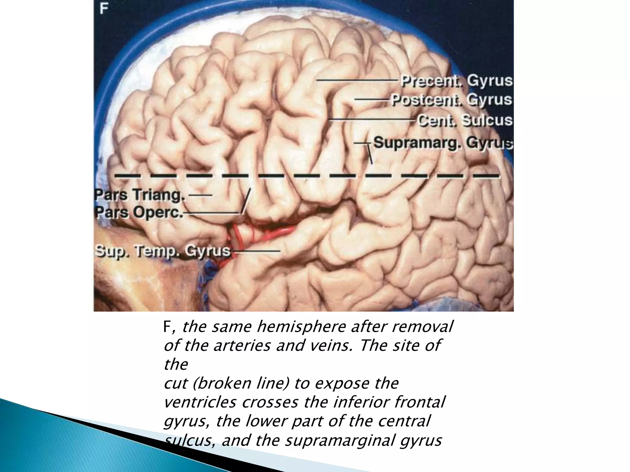 Anatomy of lateral ventricle | PPTX