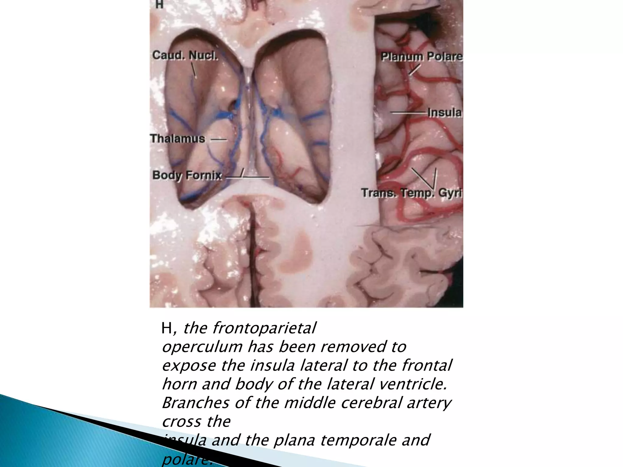 Anatomy of lateral ventricle | PPTX