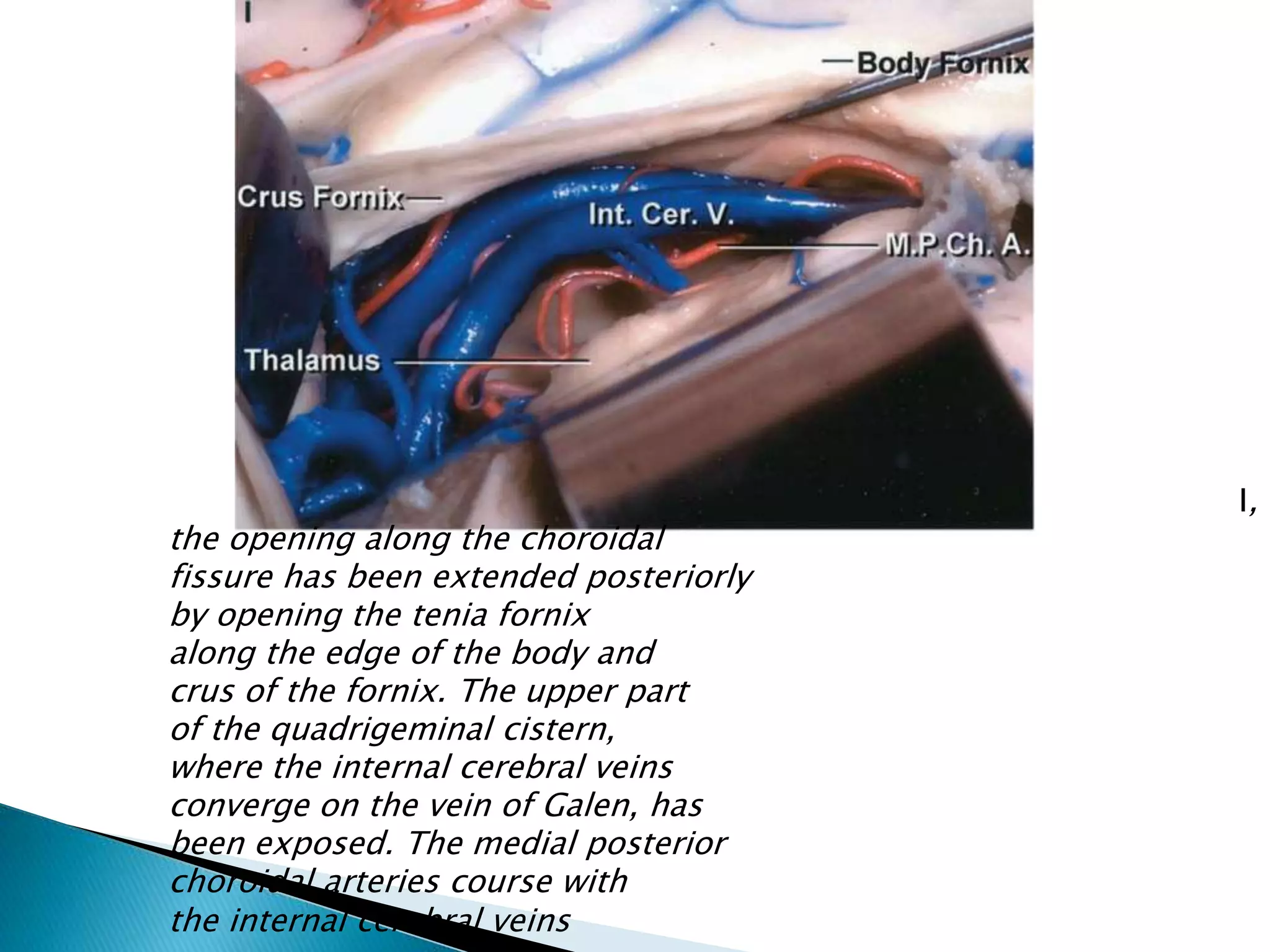 Anatomy of lateral ventricle | PPTX