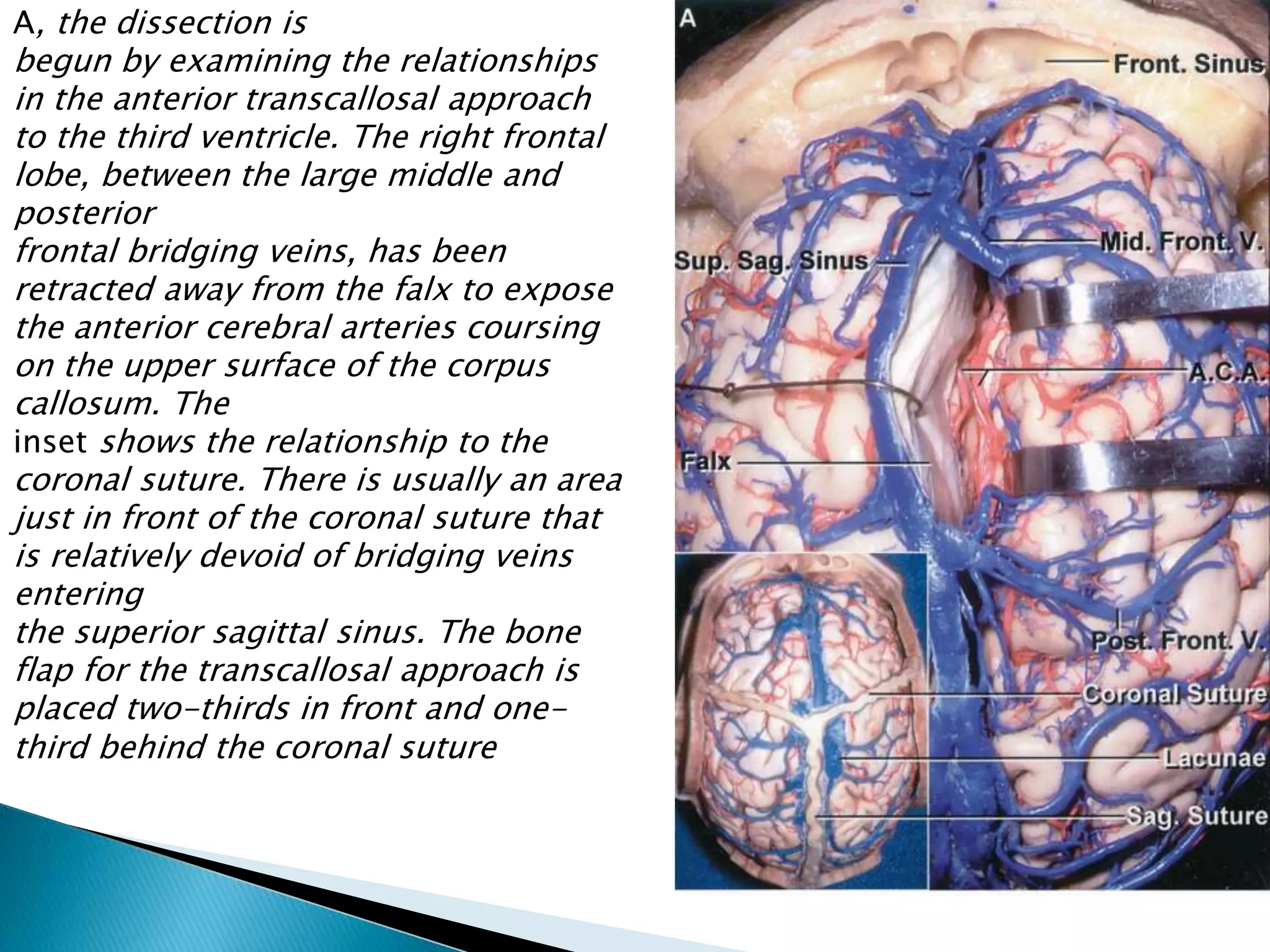 Anatomy of lateral ventricle | PPTX