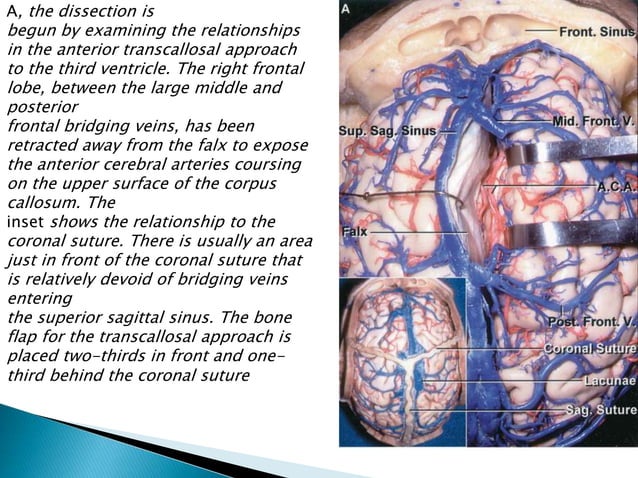 Anatomy of lateral ventricle | PPTX | Brain and Nervous System ...