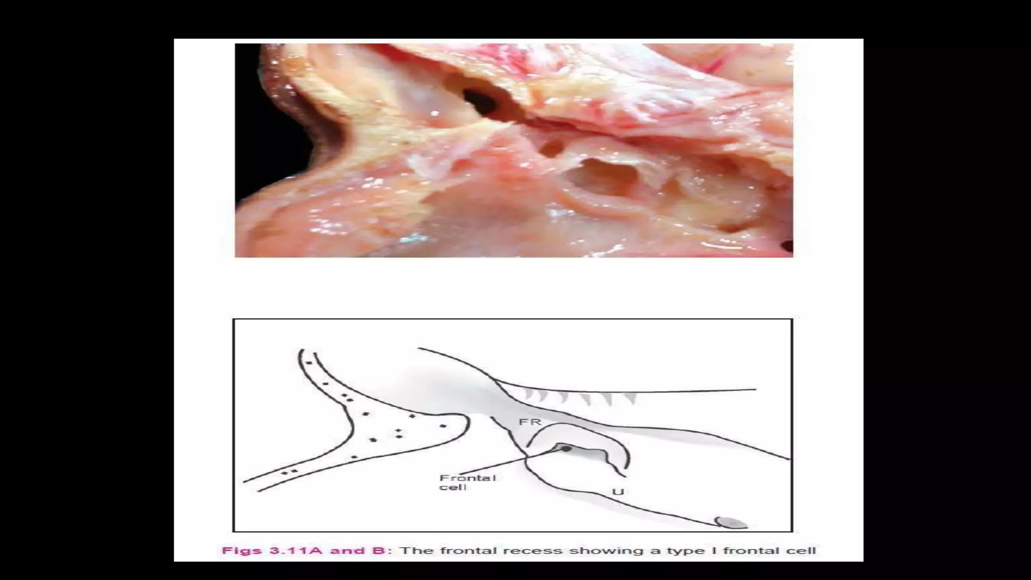 Anatomy of lateral wall of nose | PPTX | Ear, Nose and Throat ...