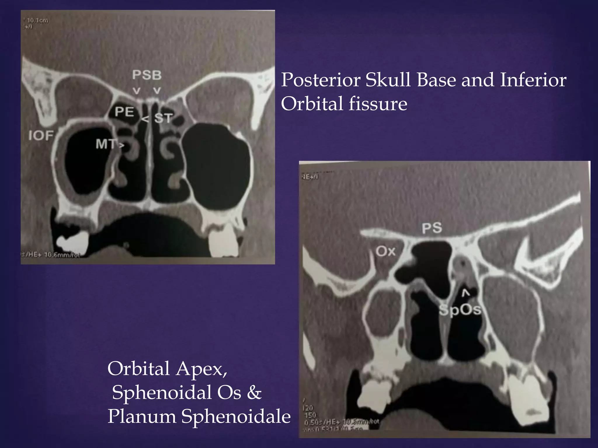 Anatomy of lateral wall of nose with relevance | PPTX