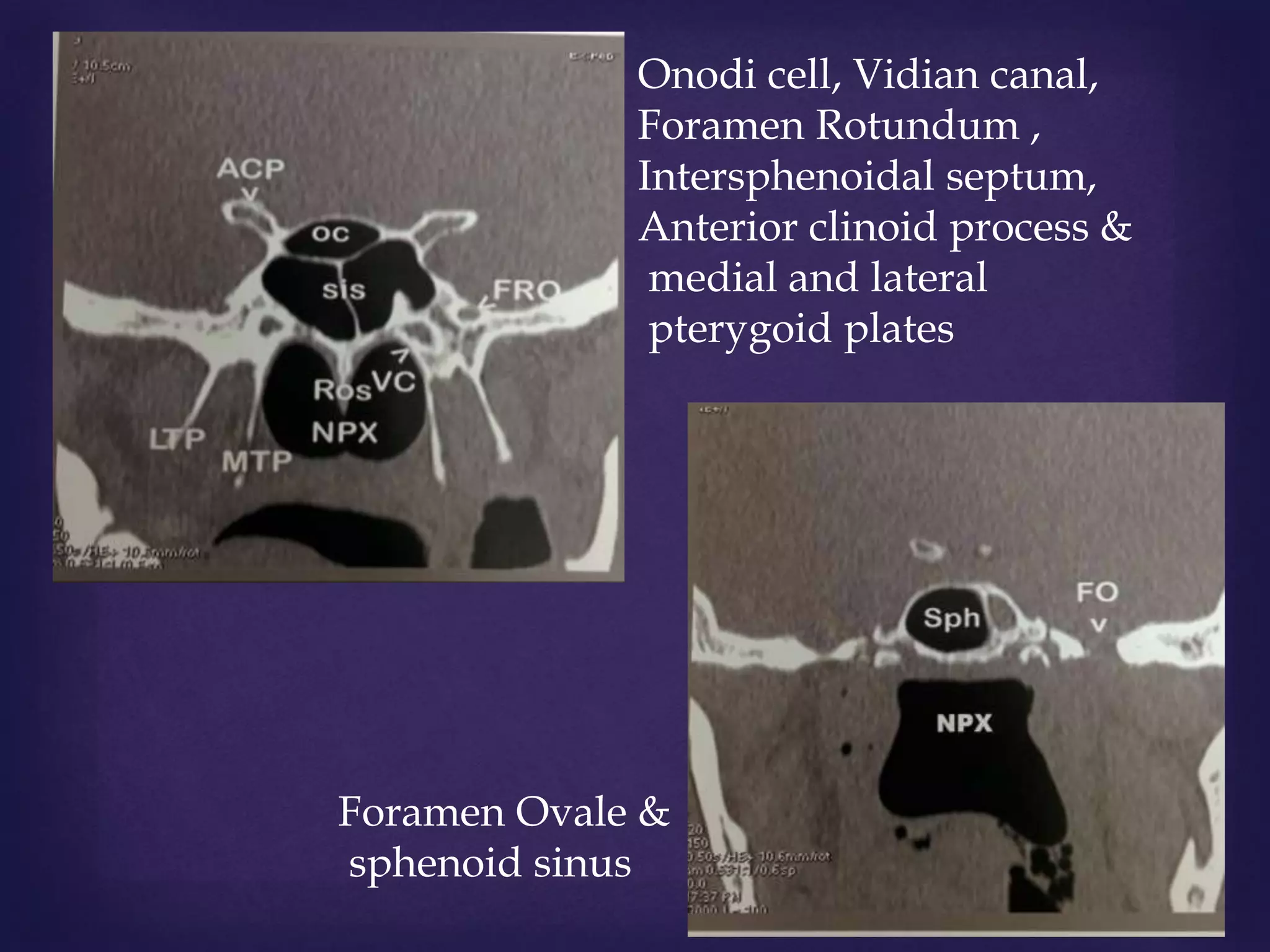 Anatomy of lateral wall of nose with relevance | PPTX