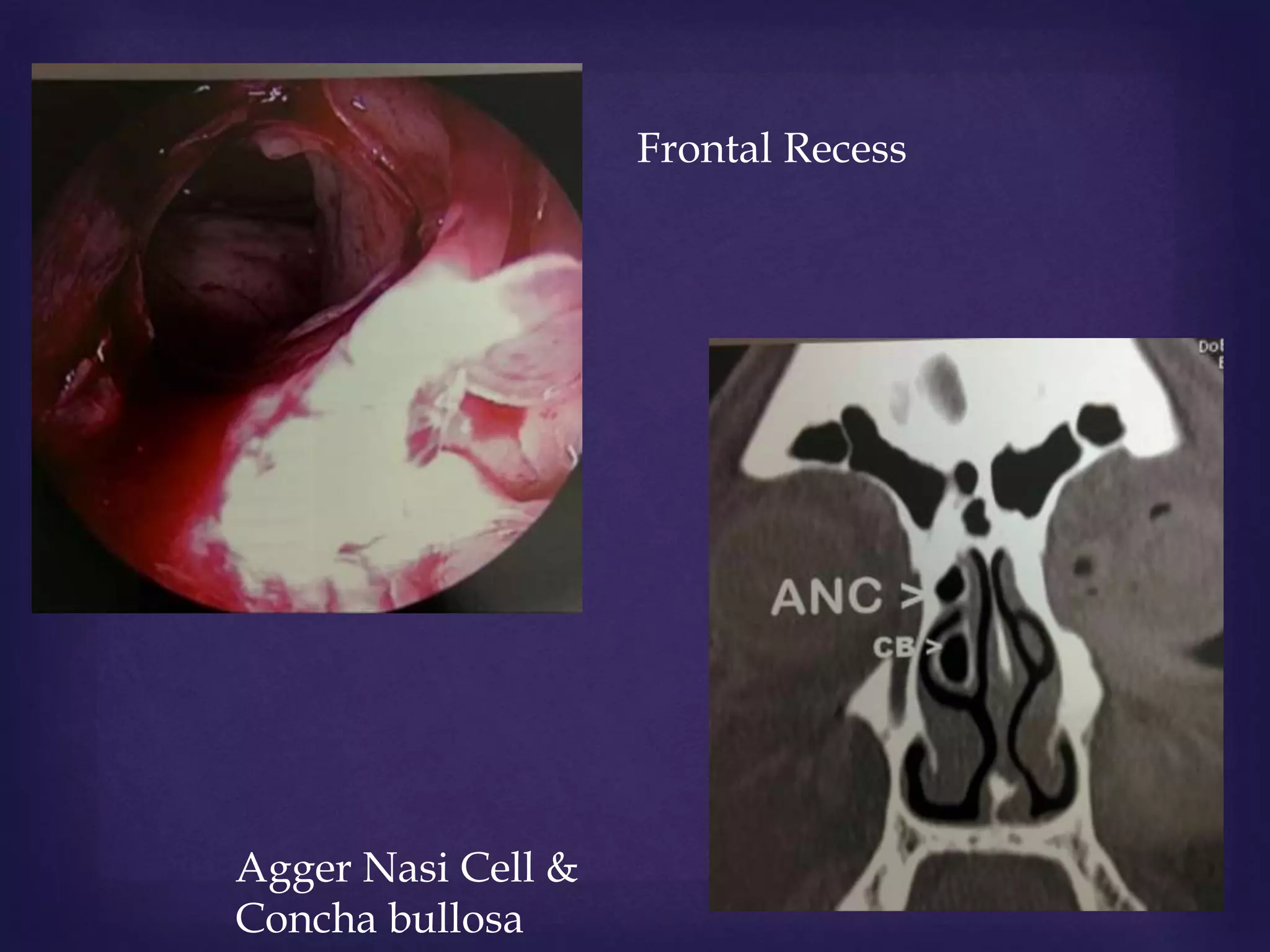 Anatomy of lateral wall of nose with relevance | PPTX