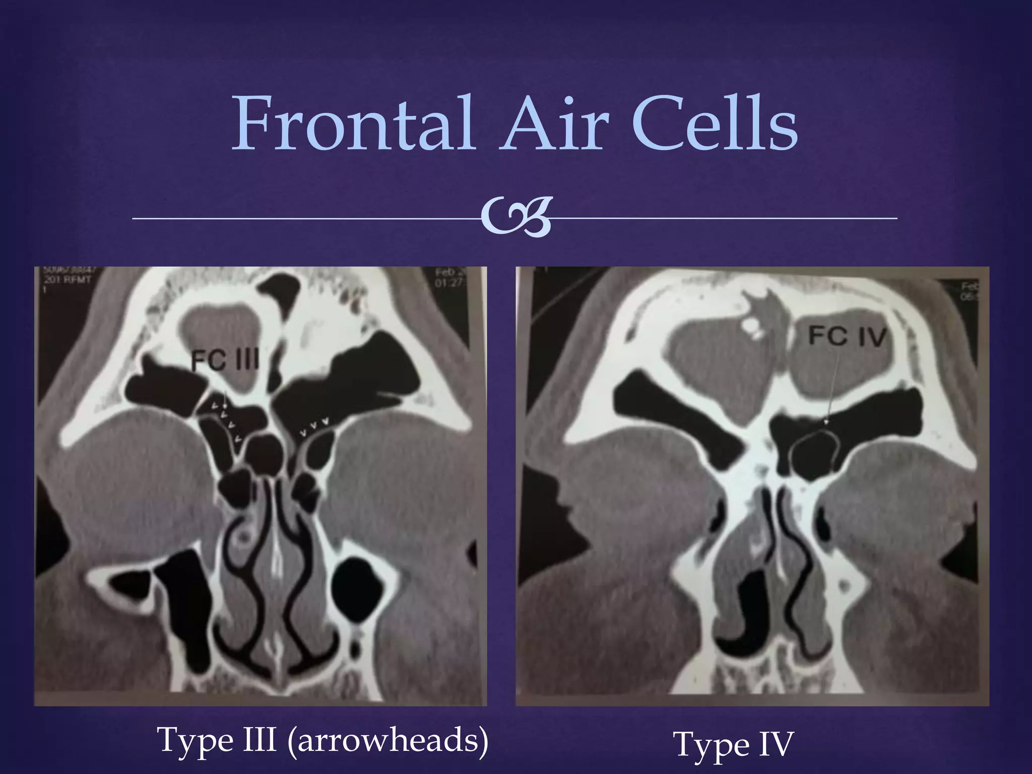 Anatomy of lateral wall of nose with relevance | PPTX