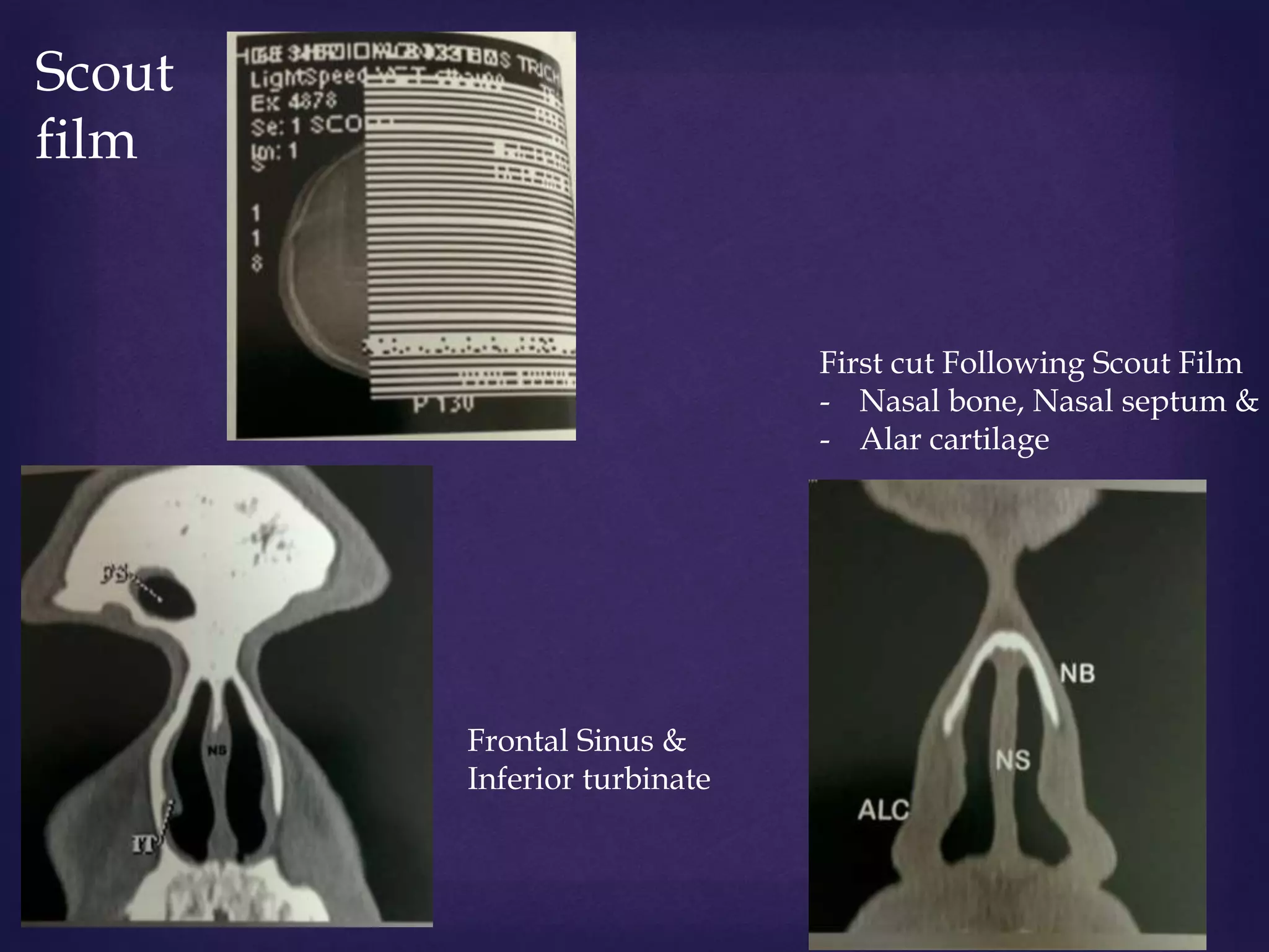 Anatomy of lateral wall of nose with relevance | PPTX