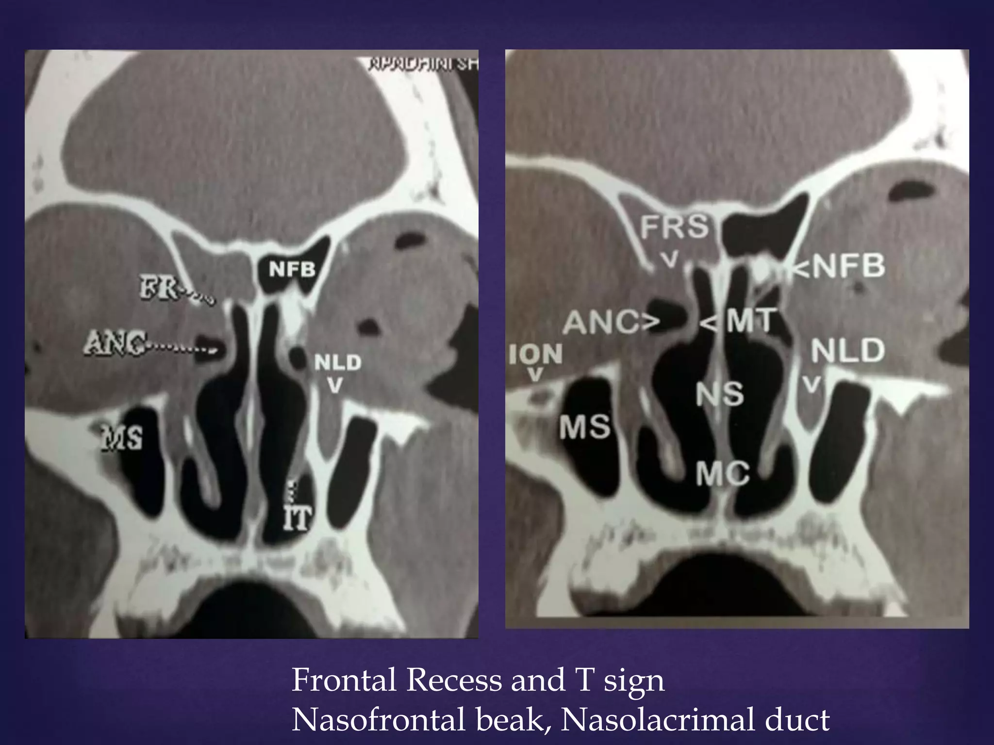 Anatomy of lateral wall of nose with relevance | PPTX