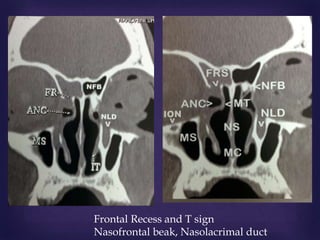 Anatomy of lateral wall of nose with relevance | PPTX