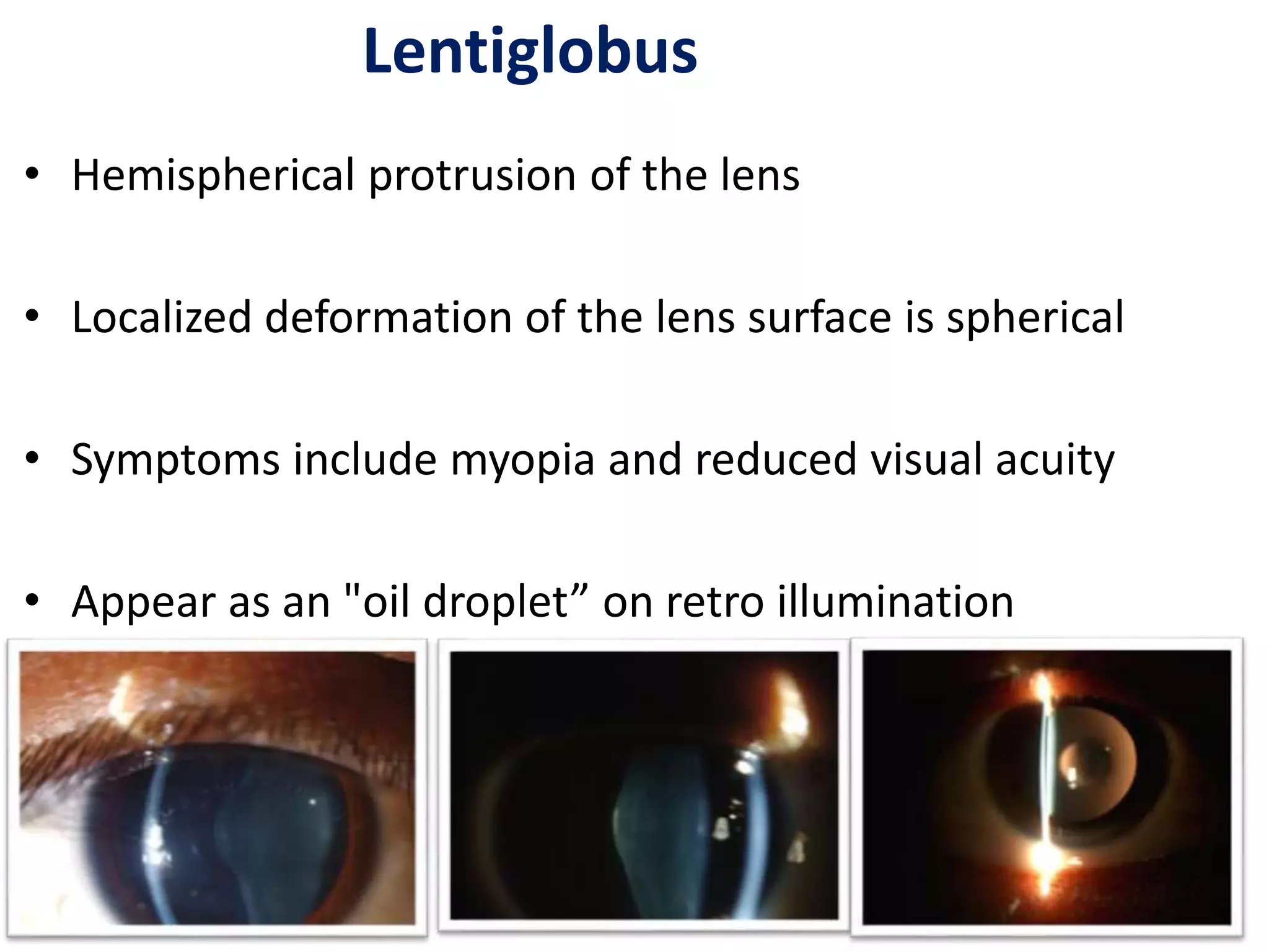 Anatomy of lens | PPTX