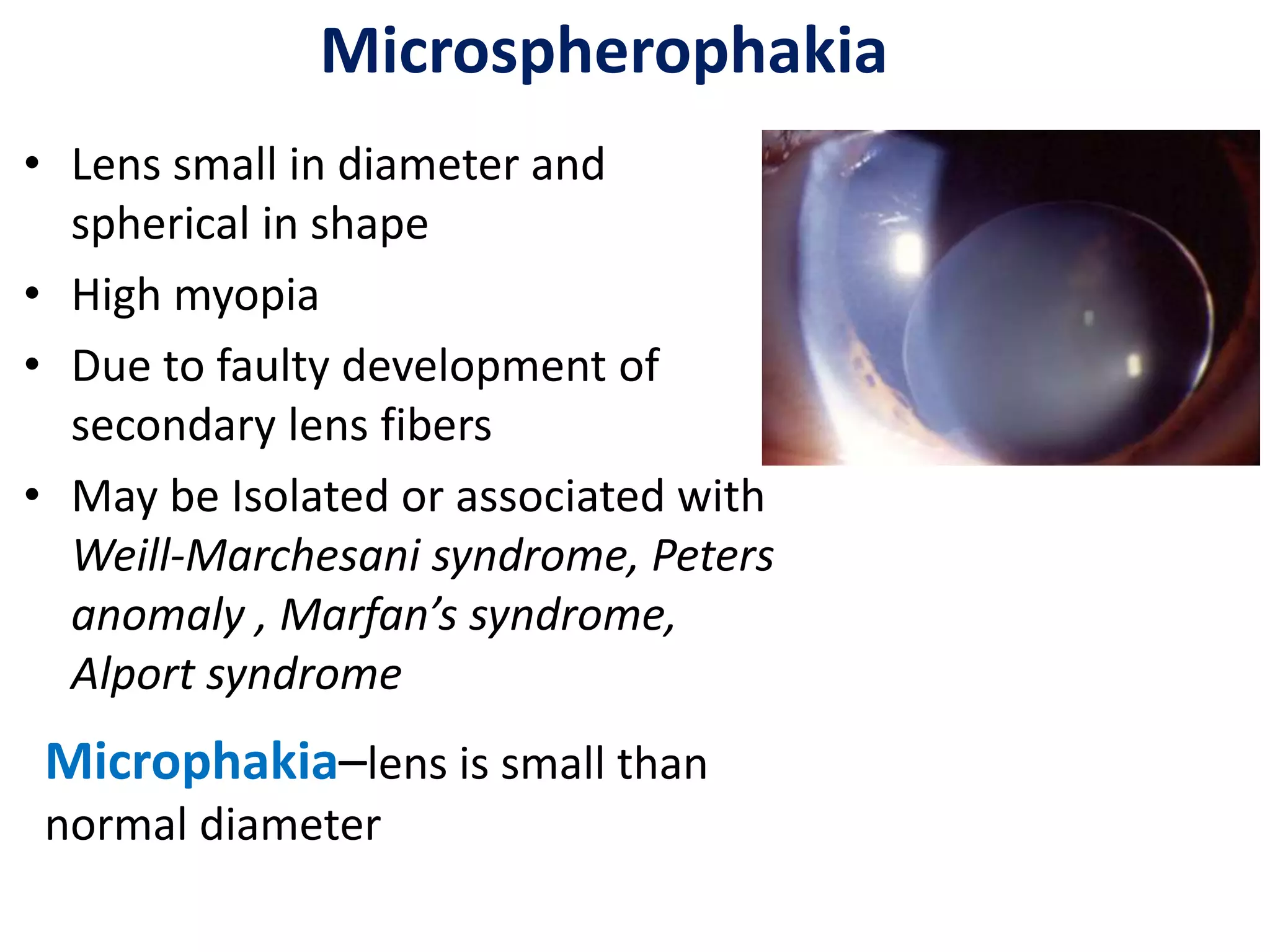 Anatomy of lens | PPTX