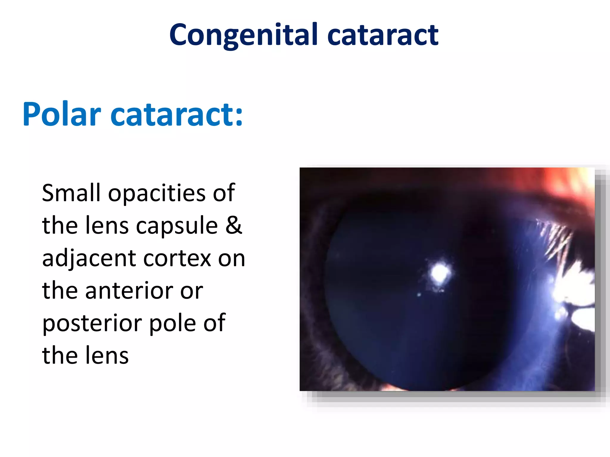 Anatomy of lens | PPTX
