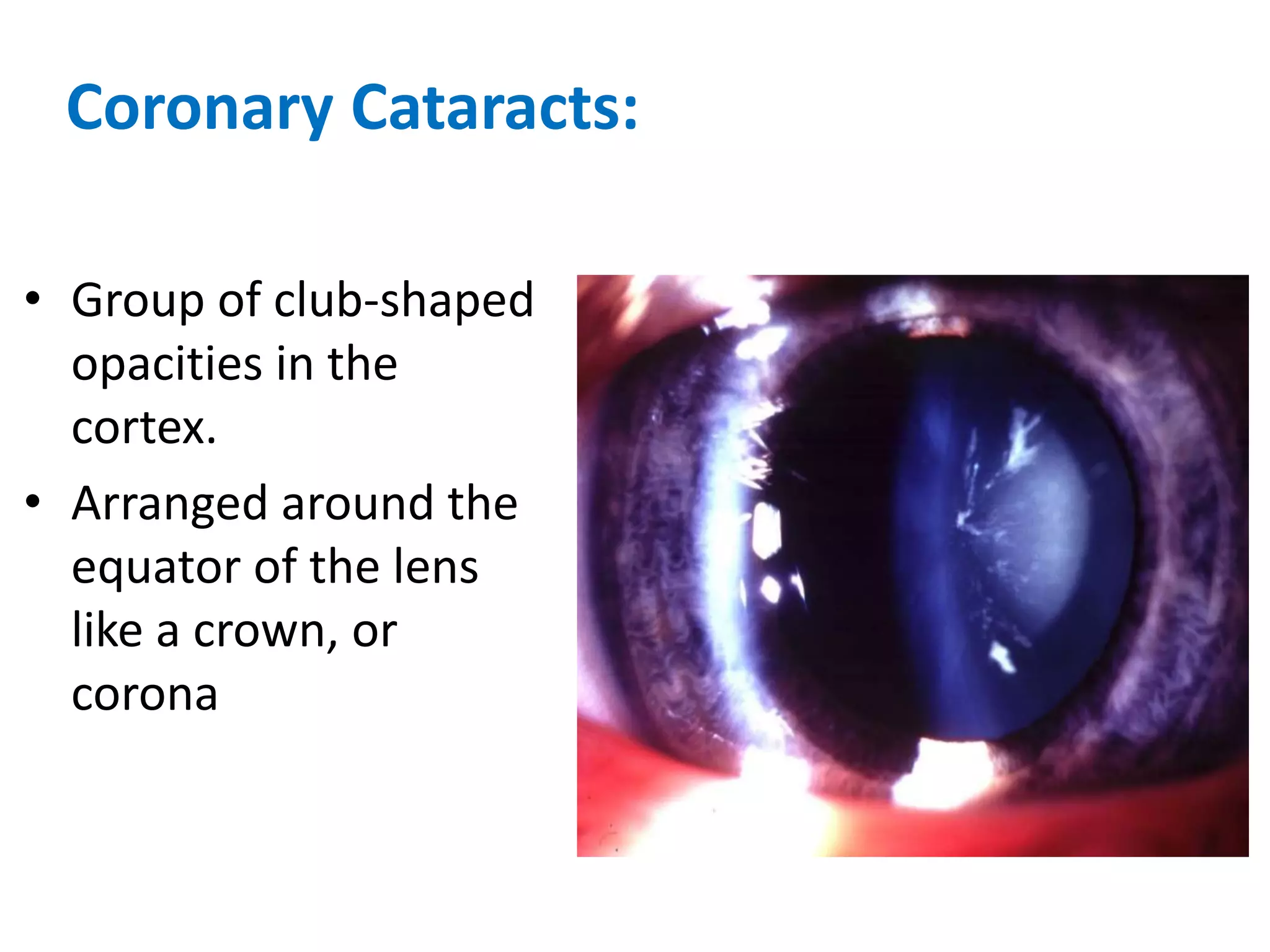 Anatomy of lens | PPTX