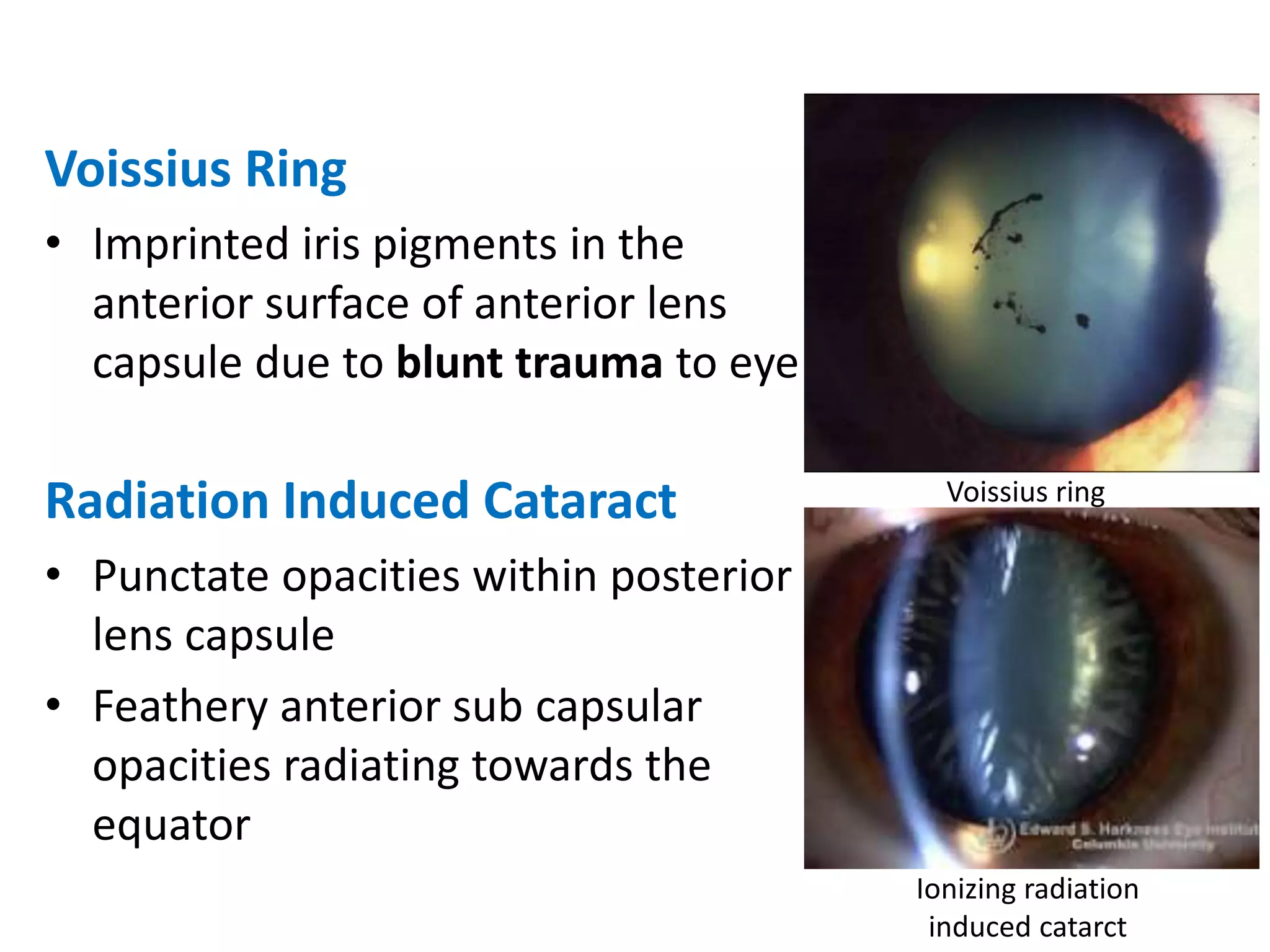Anatomy of lens | PPTX
