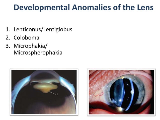 Anatomy of lens | PPTX | Eye and Vision Conditions | Diseases and ...