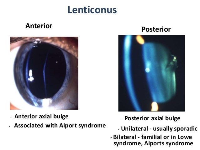 Anatomy of lens
