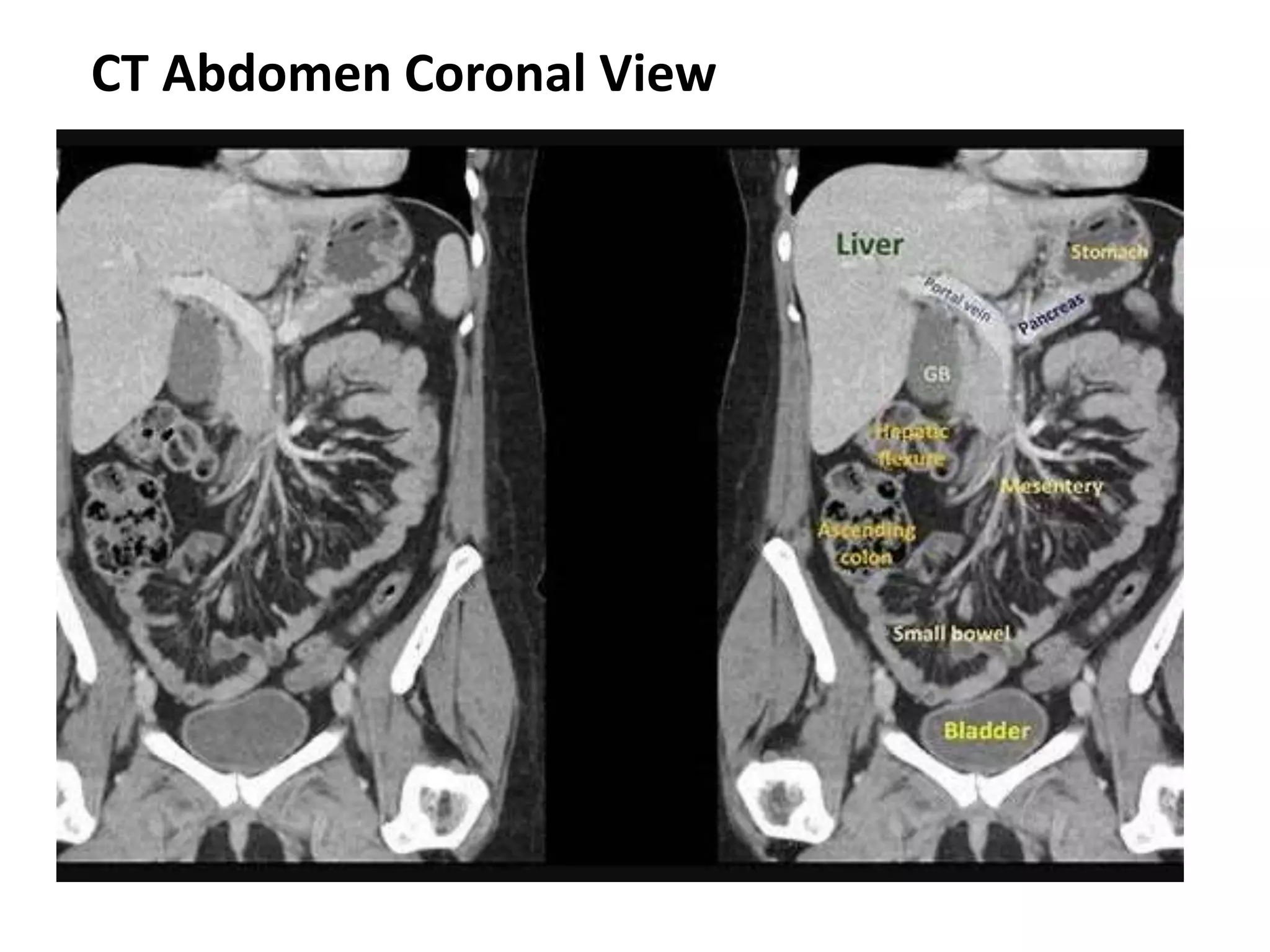 Anatomy of liver, spleen , pancreas(radiological) | PPTX