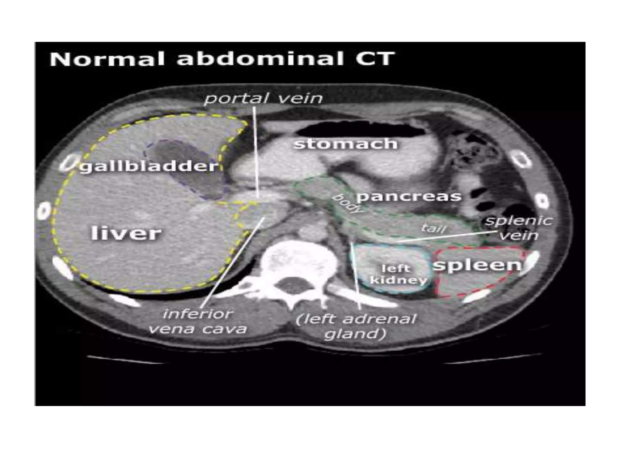 Anatomy of liver, spleen , pancreas(radiological) | PPTX