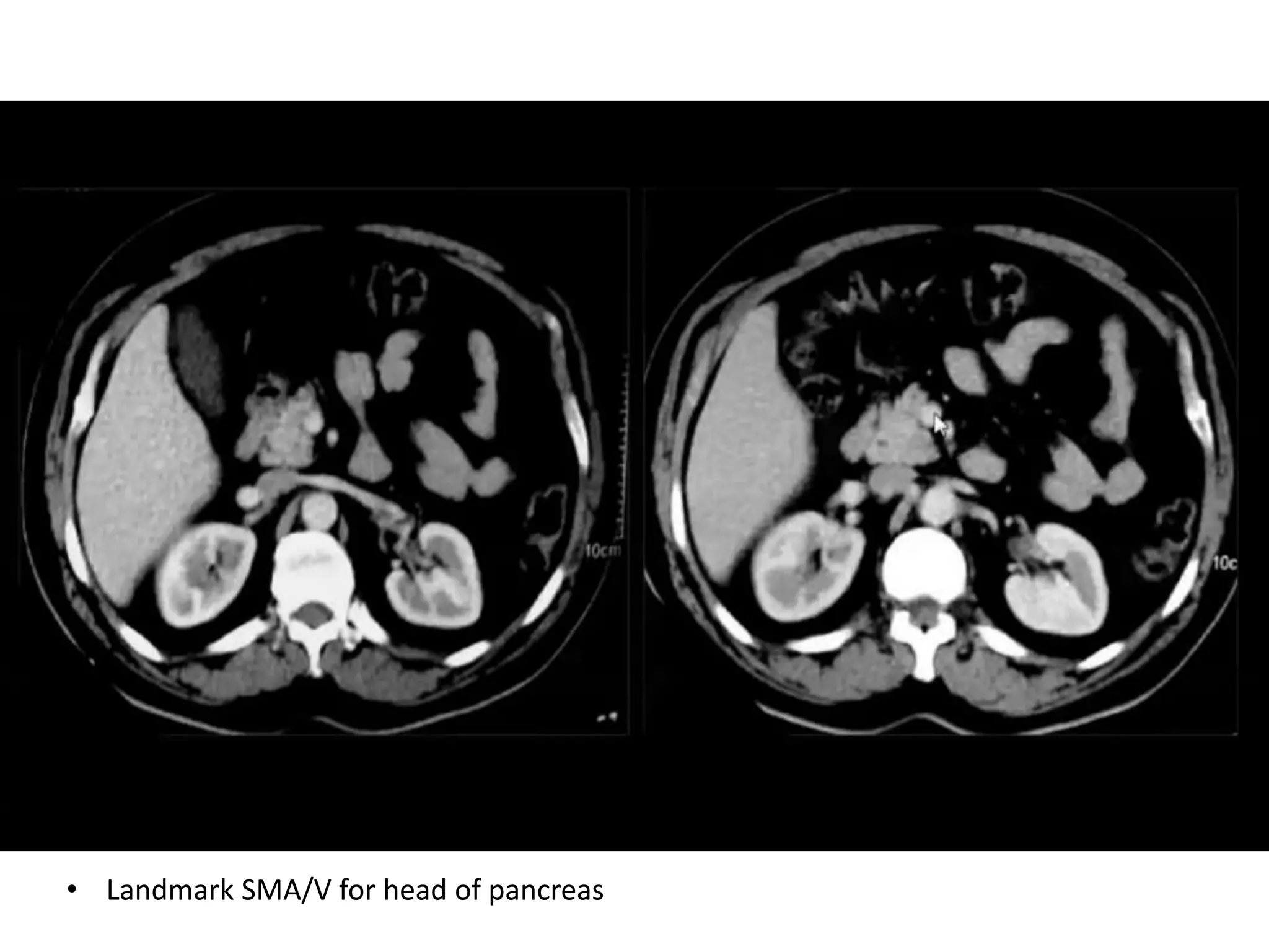 Anatomy of liver, spleen , pancreas(radiological) | PPTX