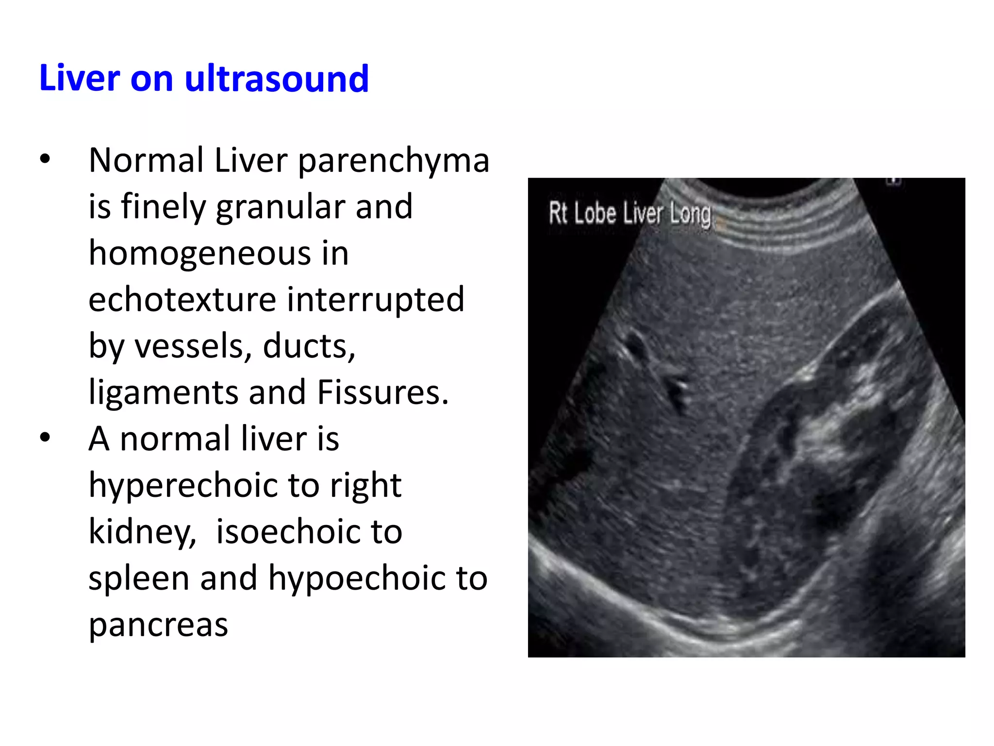Anatomy of liver, spleen , pancreas(radiological) | PPTX