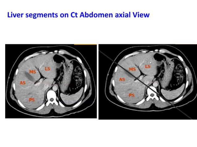 Anatomy of liver, spleen , pancreas(radiological) | PPTX | Medical Health