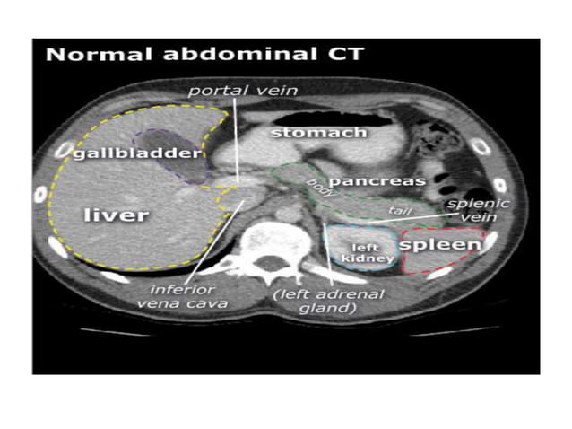 Anatomy of liver, spleen , pancreas(radiological) | PPTX | Medical Health