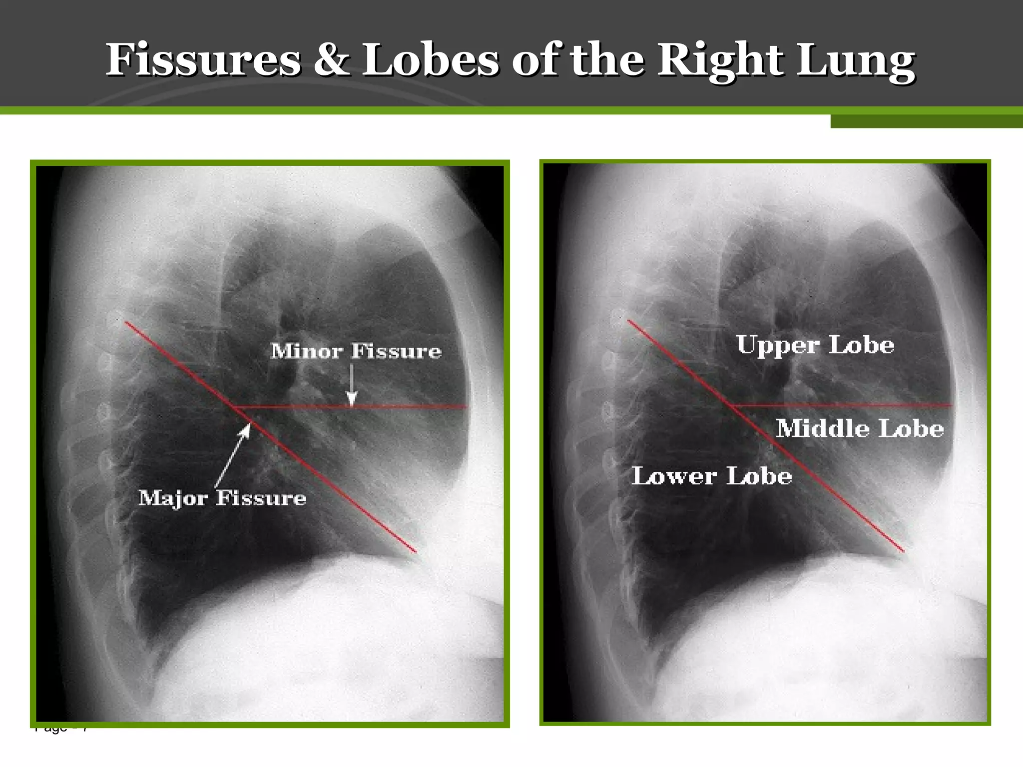 Anatomy of lung & pleura | PPT