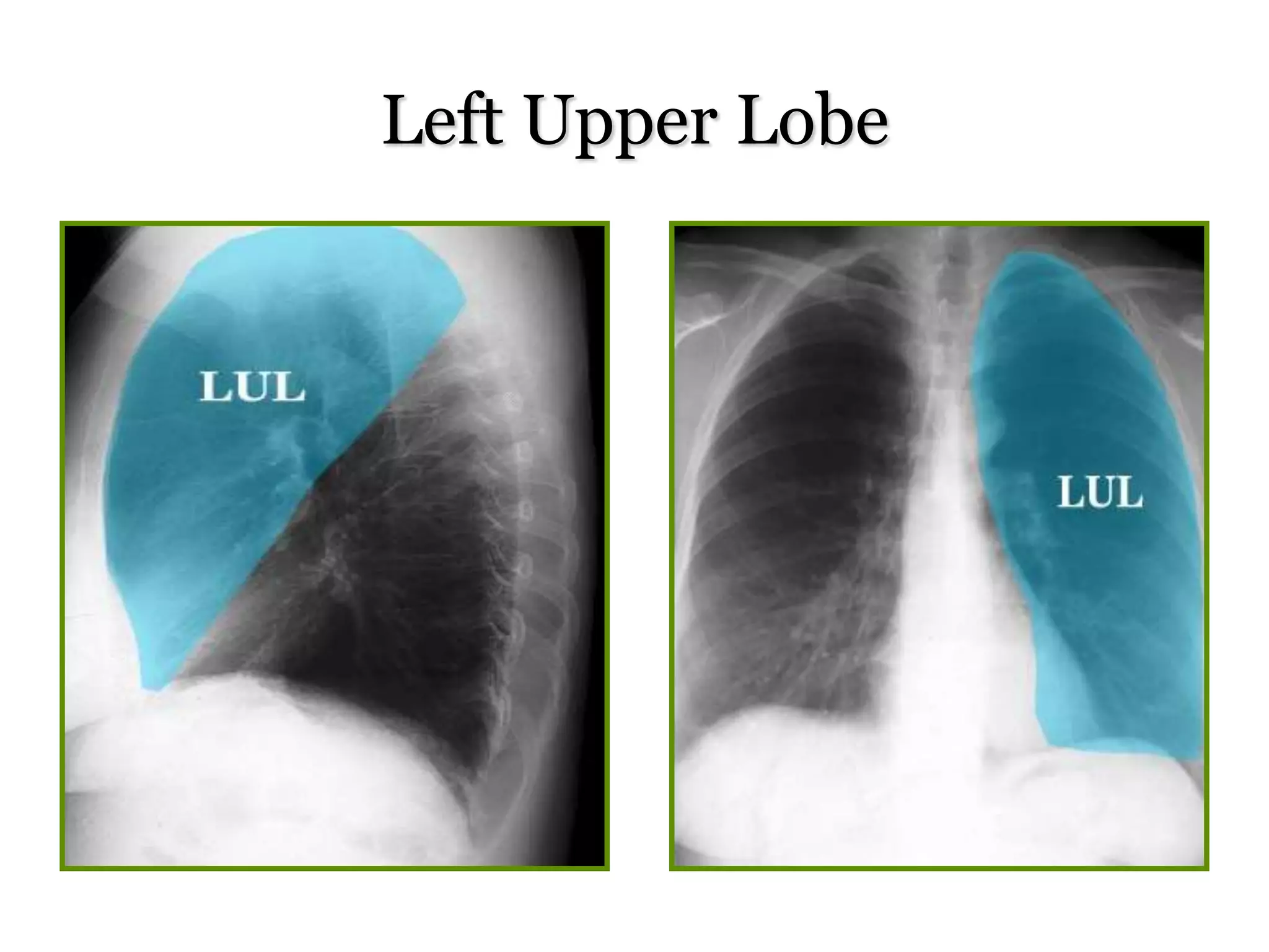 Clinical Anatomy of lungs | PPTX