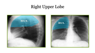 Anatomy of lungs, pleura and diaphragm | PPTX