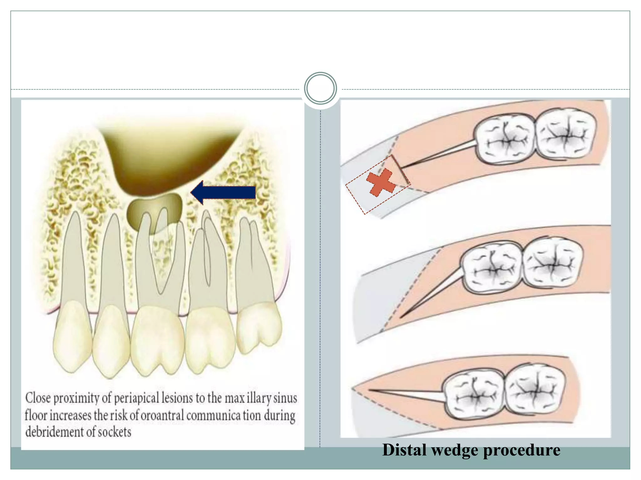 Anatomy of maxilla and its development | PPTX