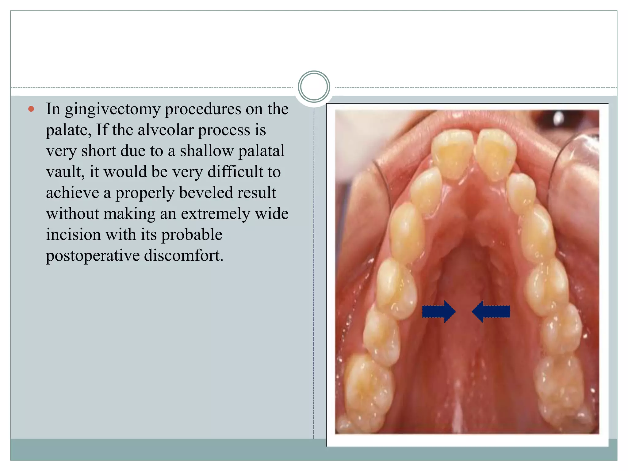 Anatomy of maxilla and its development | PPTX