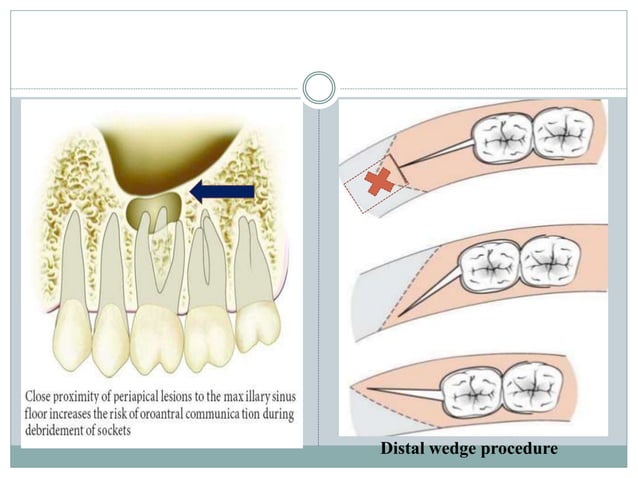 Anatomy of maxilla and its development | PPTX