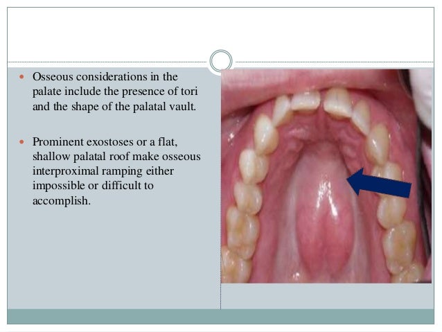 Anatomy of maxilla and its development