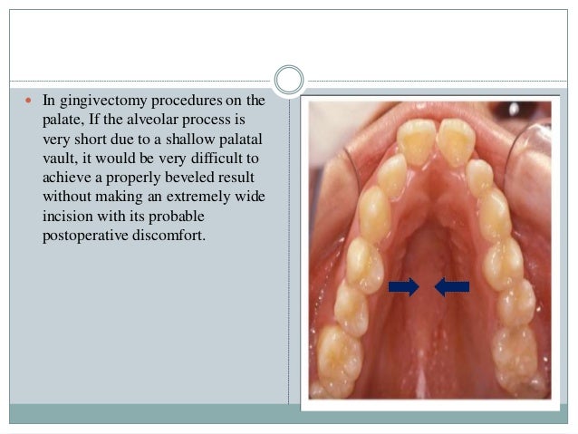 Anatomy of maxilla and its development