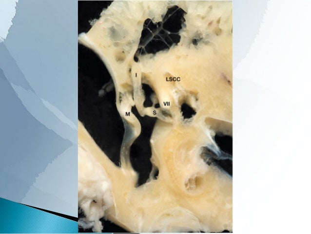 ANATOMY OF MIDDLE EAR CLEFT