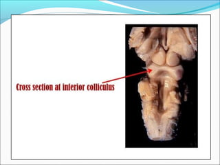 Anatomy of midbrain & pons | PPT