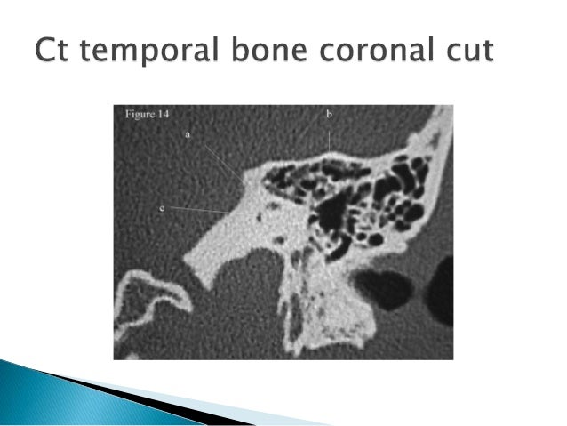 Anatomy of middle ear