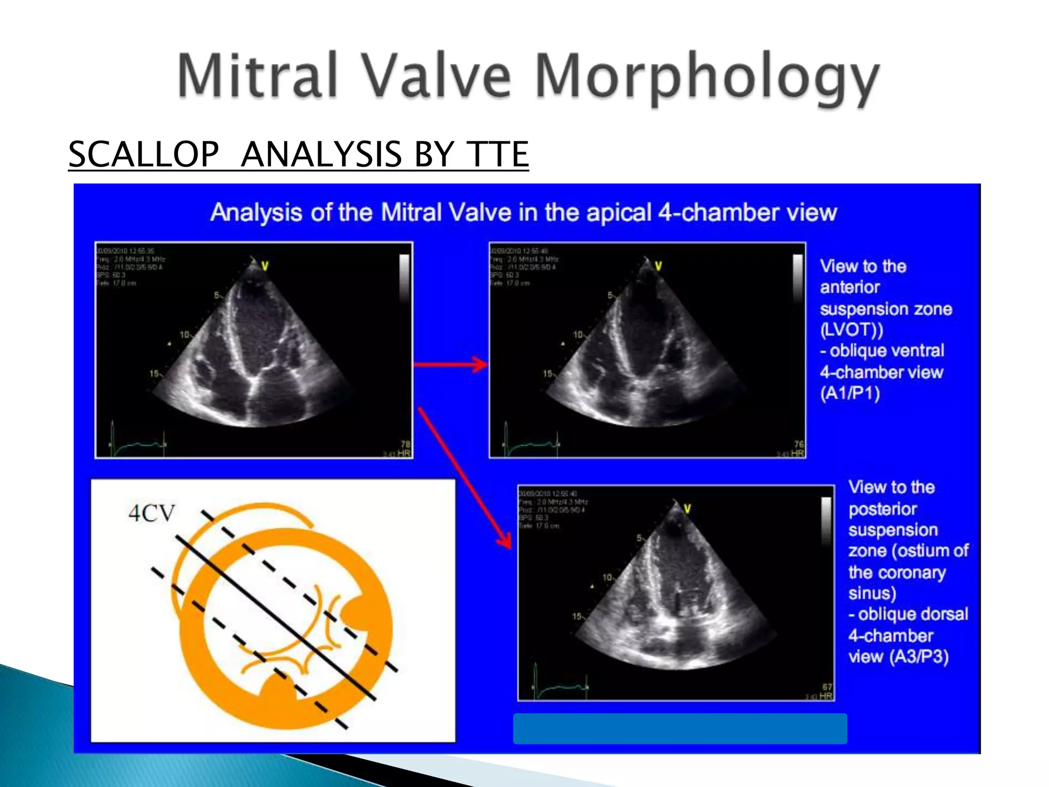 Anatomy of mitral valve echo evaluation | PPTX