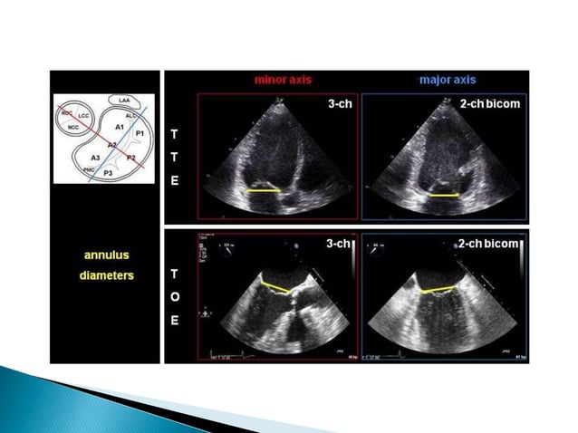 Anatomy of mitral valve echo evaluation | PPTX