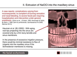 Anatomy of NaOCl accidents involving facial ecchymosis.pptx