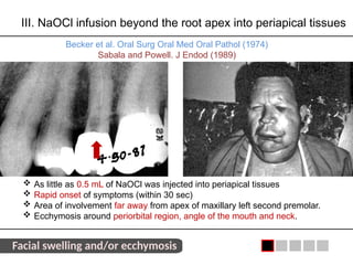 Anatomy of NaOCl accidents involving facial ecchymosis.pptx