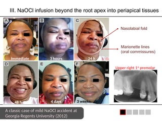 Anatomy of NaOCl accidents involving facial ecchymosis.pptx