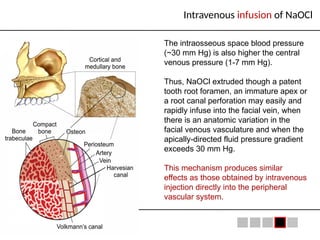 Anatomy of NaOCl accidents involving facial ecchymosis.pptx