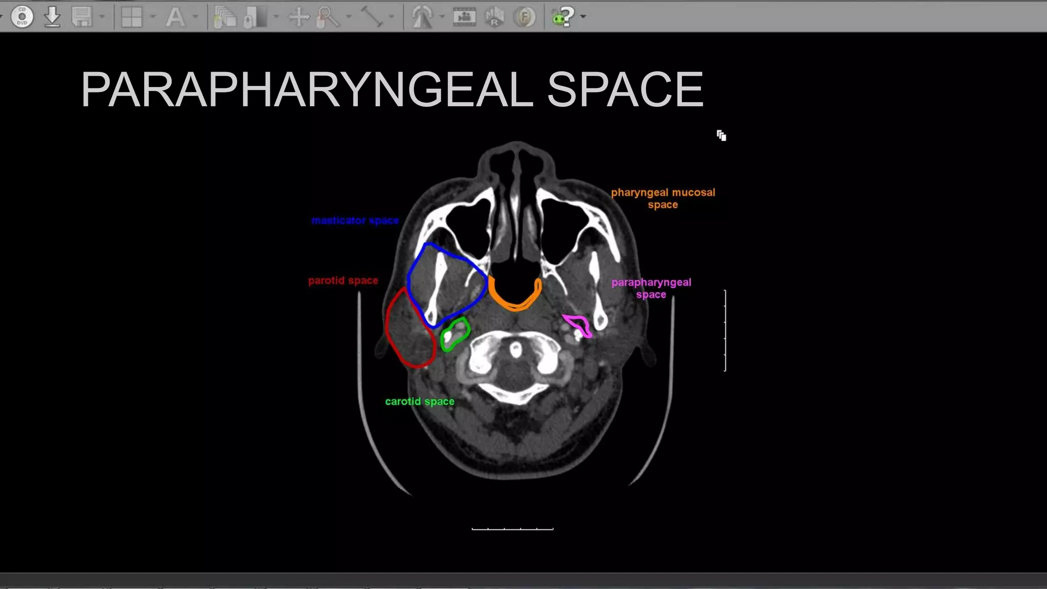 Anatomy of deep neck spaces | PPTX