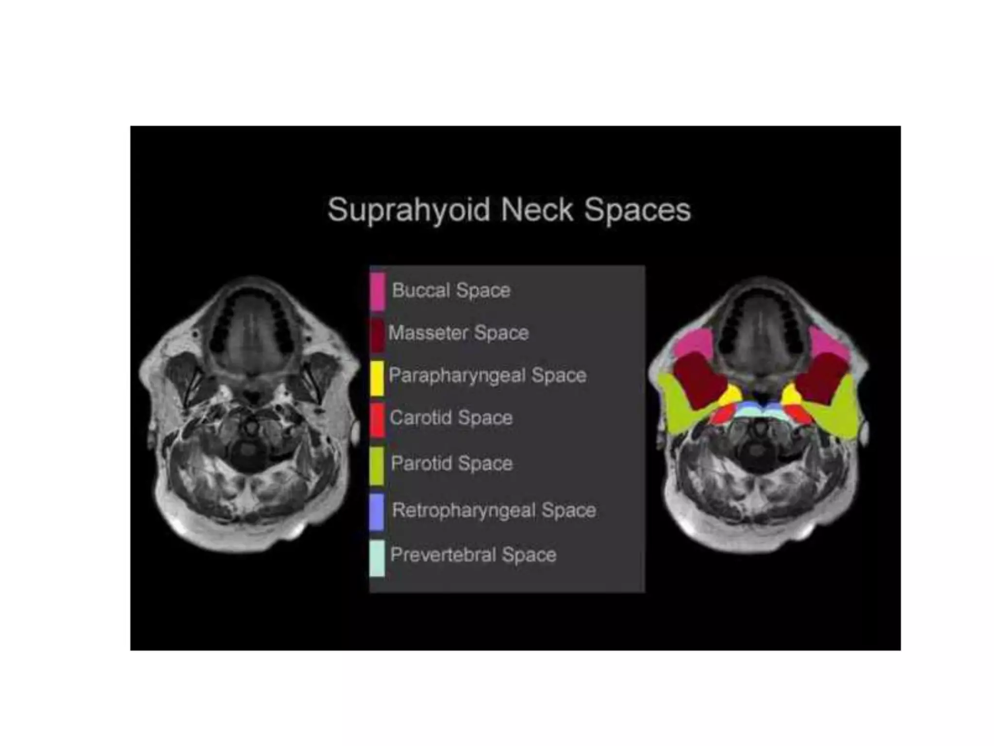 Radiological approach to neck spaces | PPTX