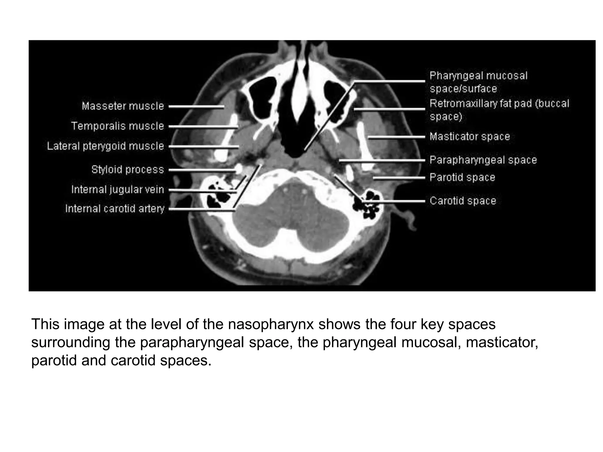 Radiological approach to neck spaces | PPTX