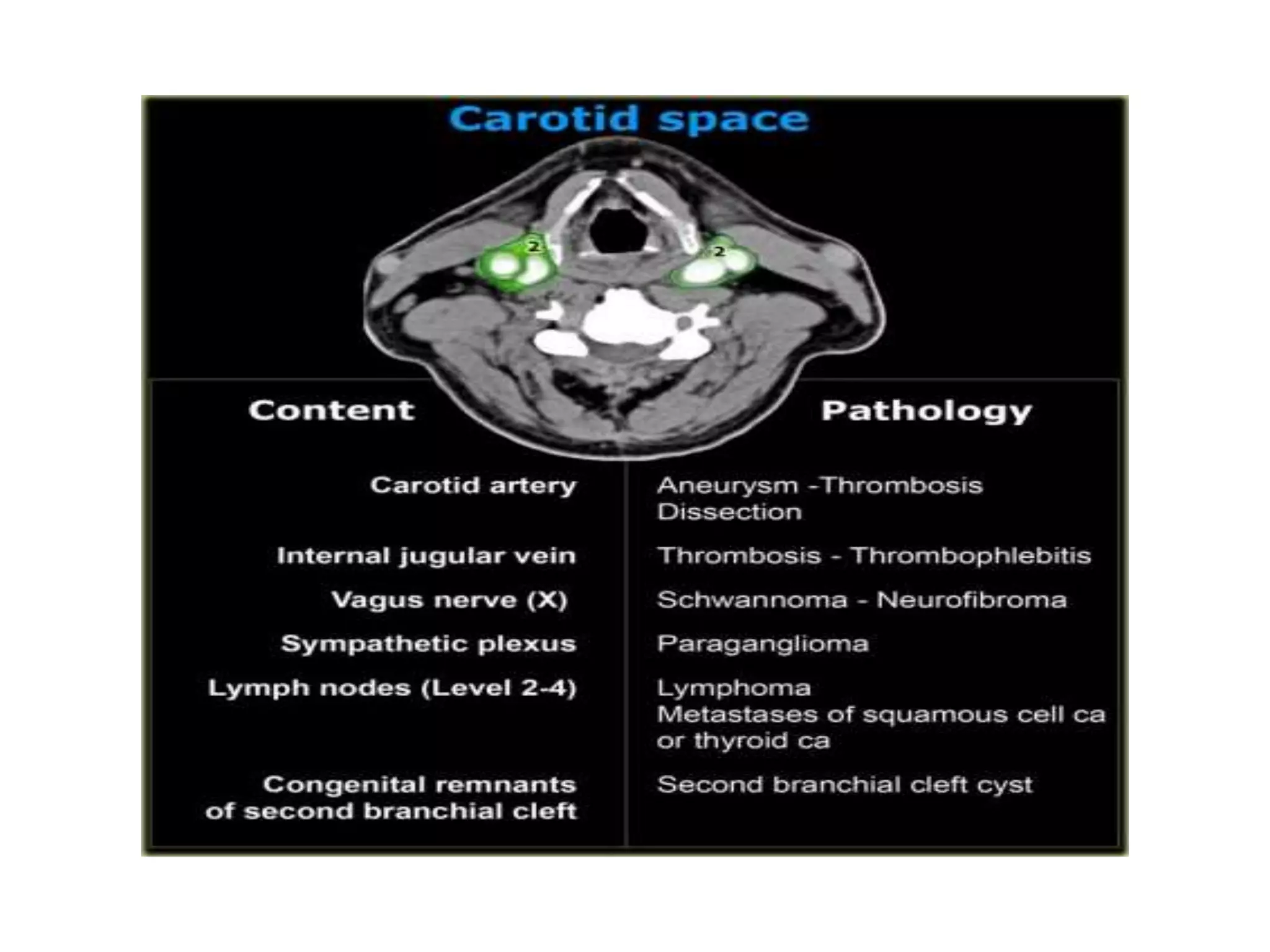 Radiological approach to neck spaces | PPTX