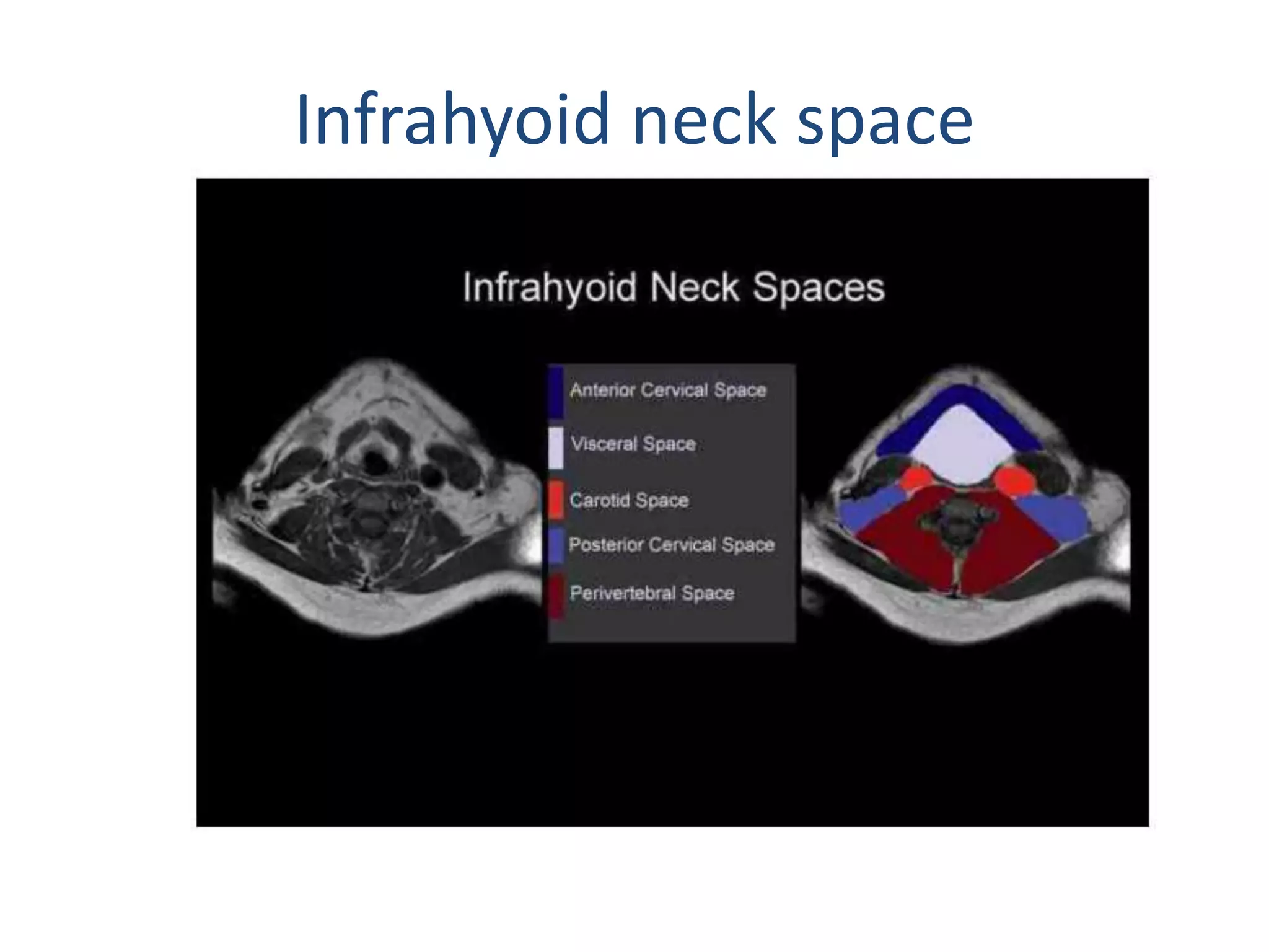Radiological approach to neck spaces | PPTX
