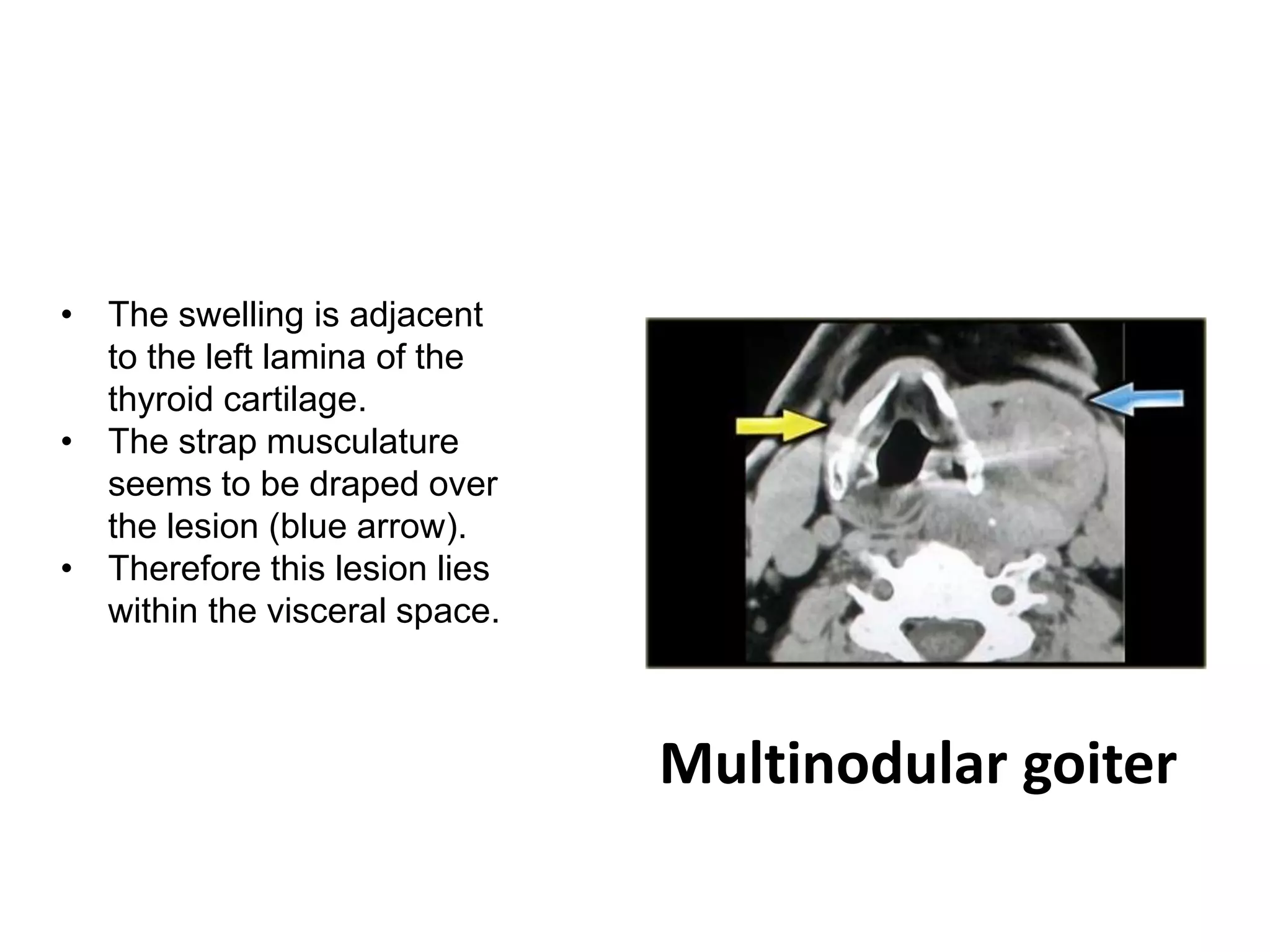 Radiological approach to neck spaces | PPTX
